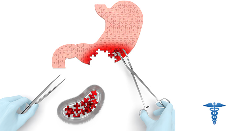 Γαστρεκτομή: Ολική Ή Υφολική Αφαίρεση Στομάχου | Ζησιάδης