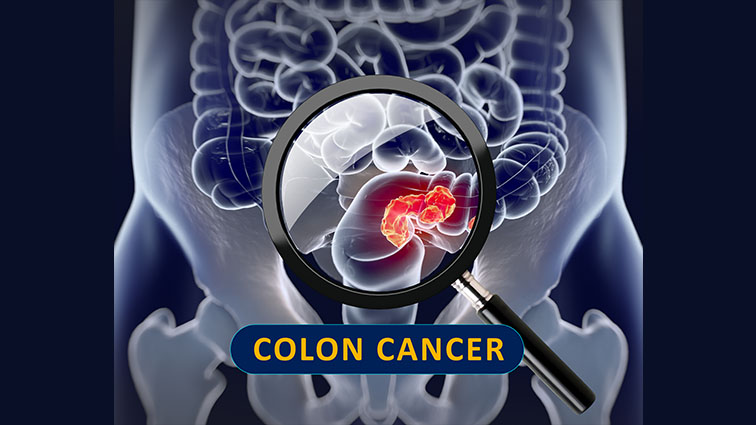 Καρκίνος Ορθού | Συμπτώματα, Διάγνωση, Αντιμετώπιση