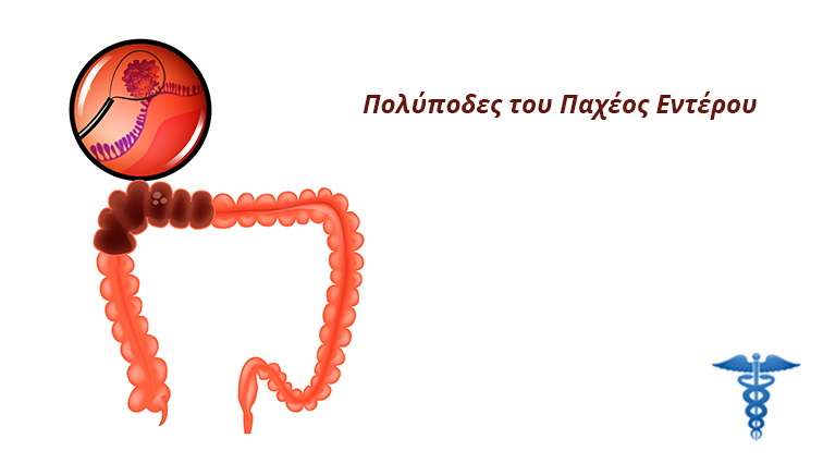 Πολύποδες Στο Παχύ Έντερο: Συμπτώματα & Εγχείρηση | Ζησιάδης